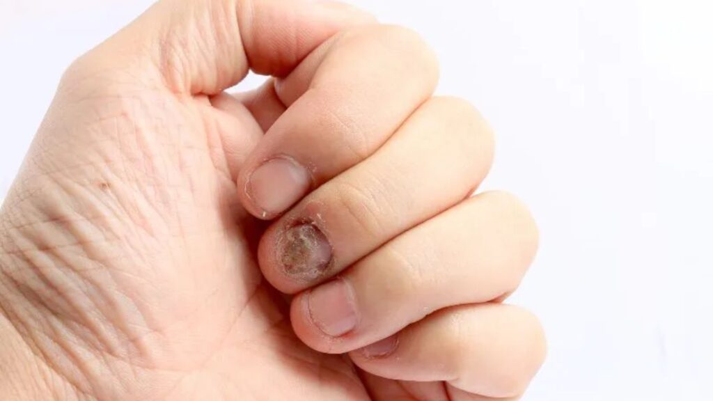 Stages of Losing a Fingernail: Injury, Healing & Recovery | TheBeautyFoodie