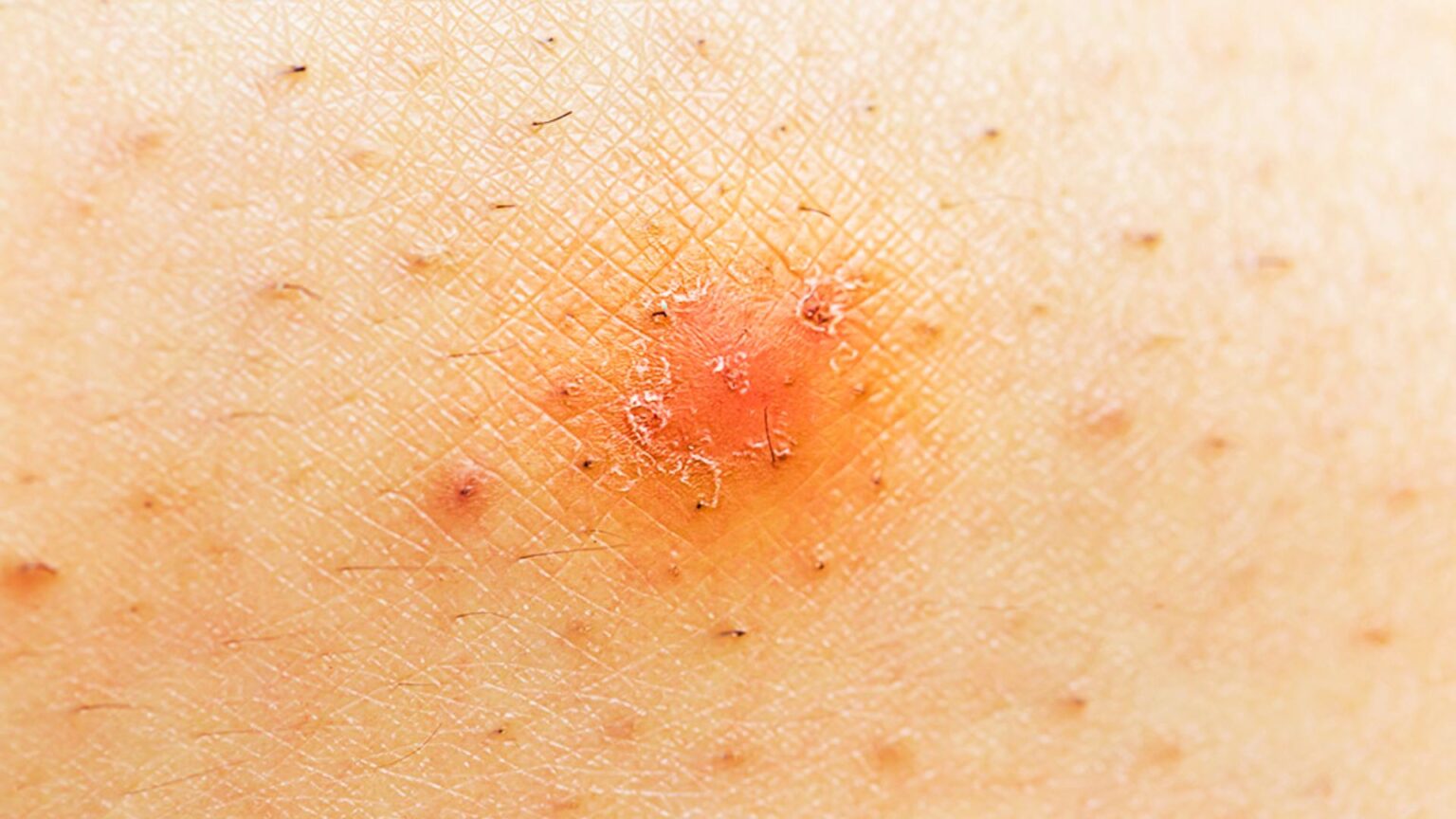 Red Bumps After Waxing: Causes, Treatment & Prevention | TheBeautyFoodie