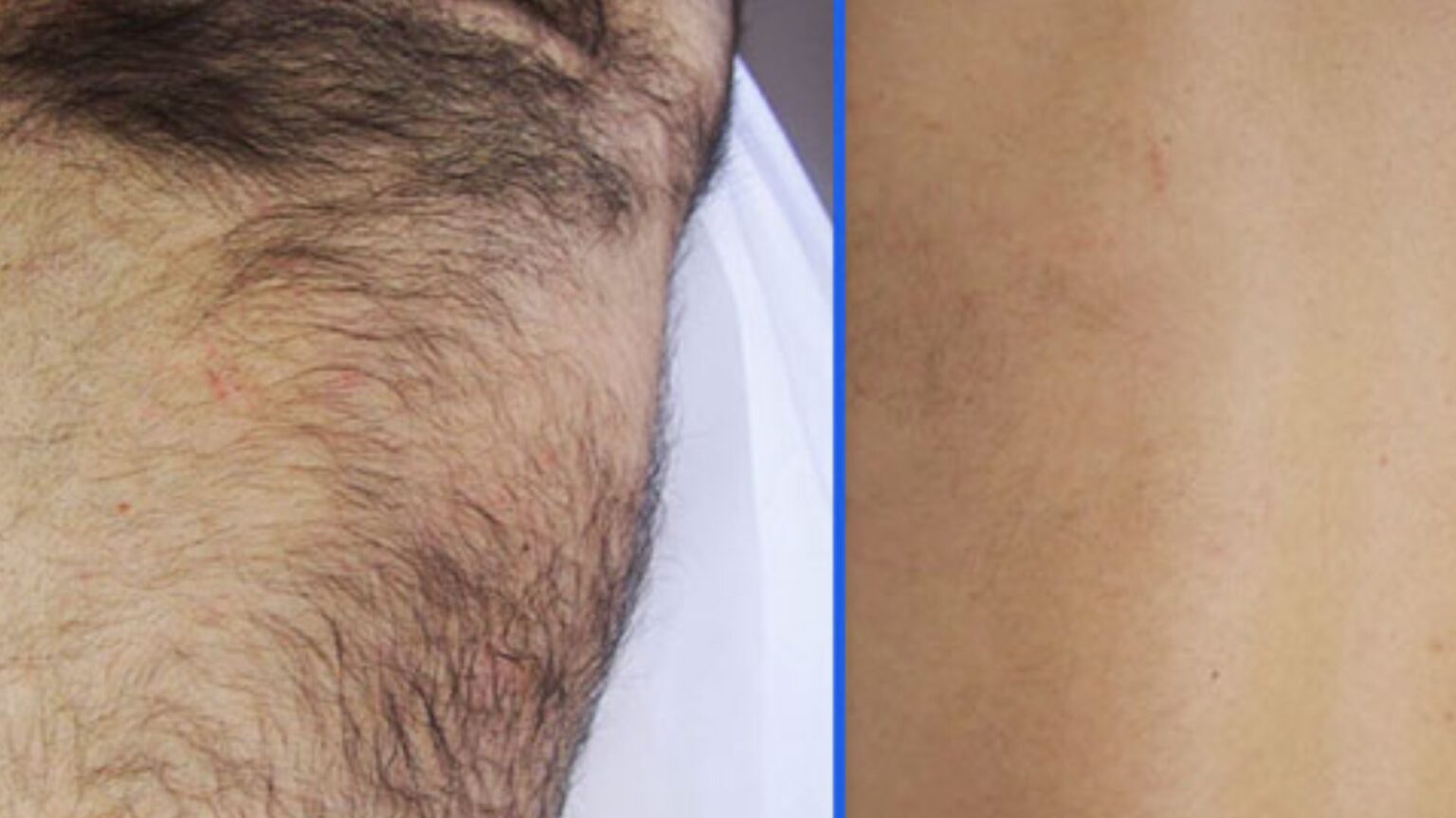 Manzilian Before and After: Real Results You’ll See | TheBeautyFoodie