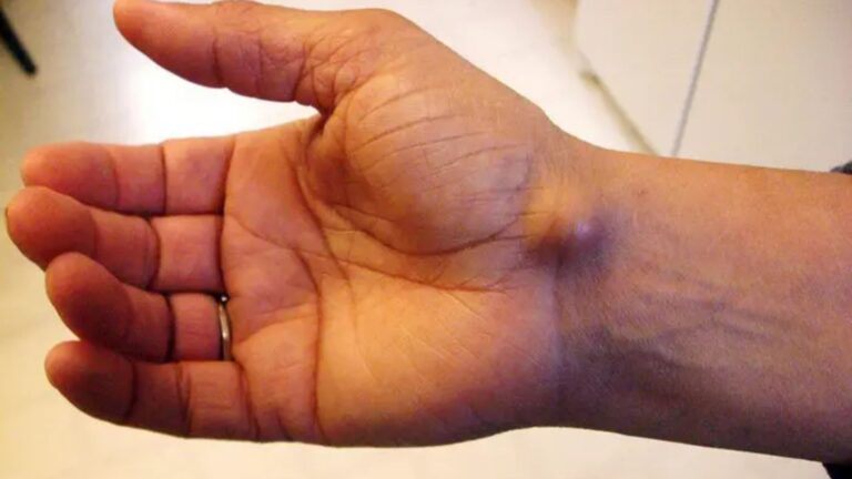 Cyst vs Pimple: How to Tell the Difference Fast | TheBeautyFoodie