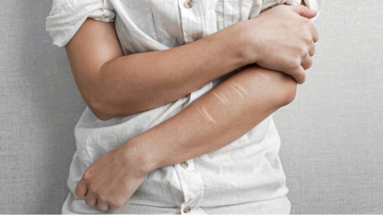 What Do SH Scars Look Like? Signs, Colors, and Patterns | TheBeautyFoodie