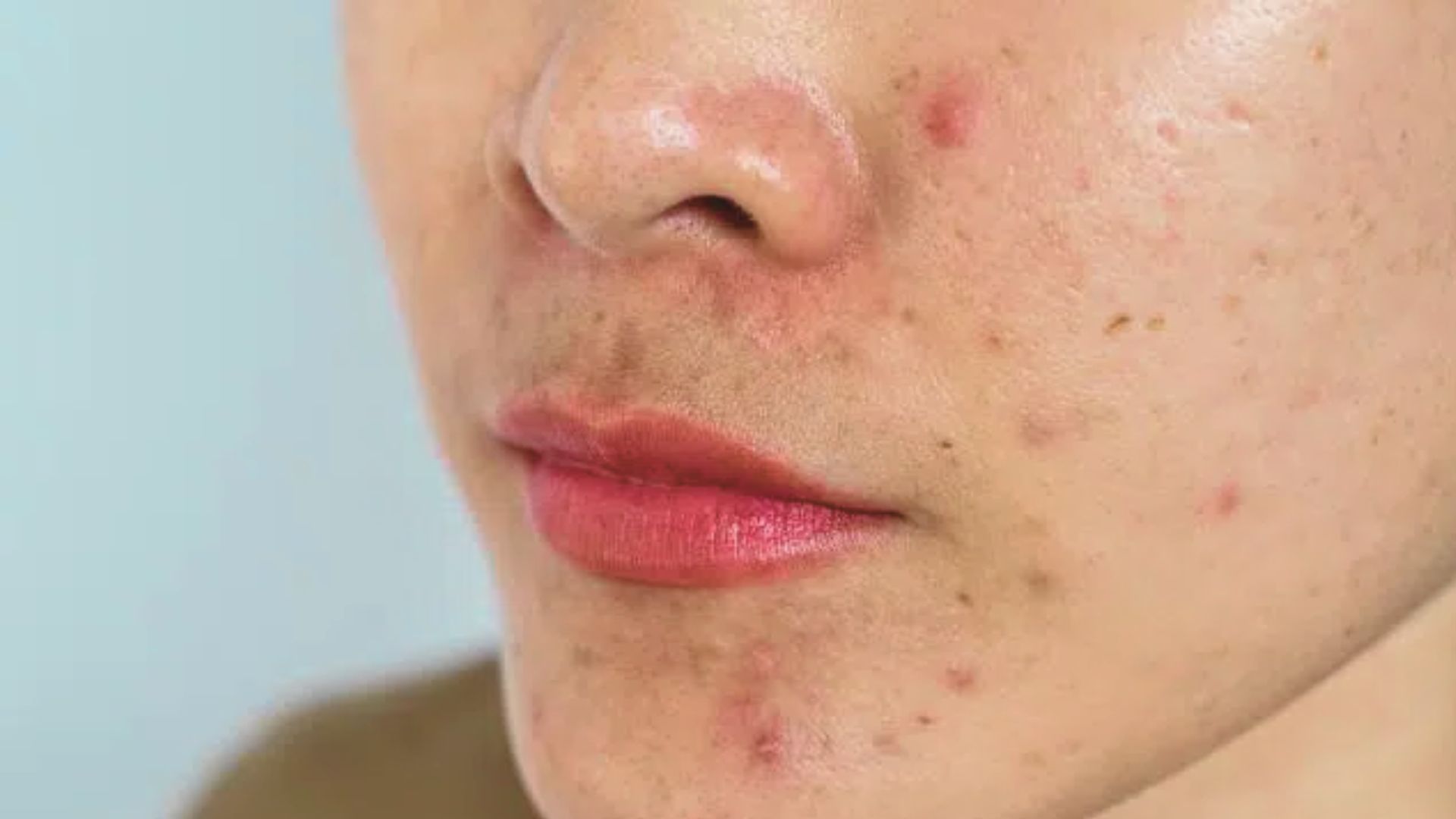 Does Vaping Cause Acne? Science & Skin Effects | TheBeautyFoodie