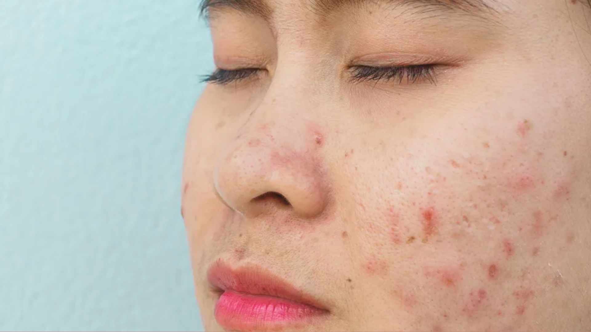 Does Vaping Cause Acne? Science & Skin Effects | TheBeautyFoodie