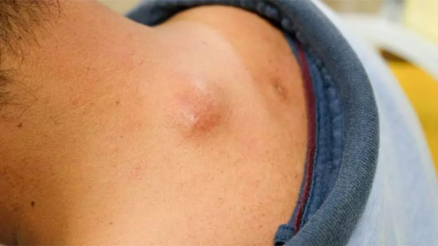 Cyst vs Pimple: How to Tell the Difference Fast | TheBeautyFoodie