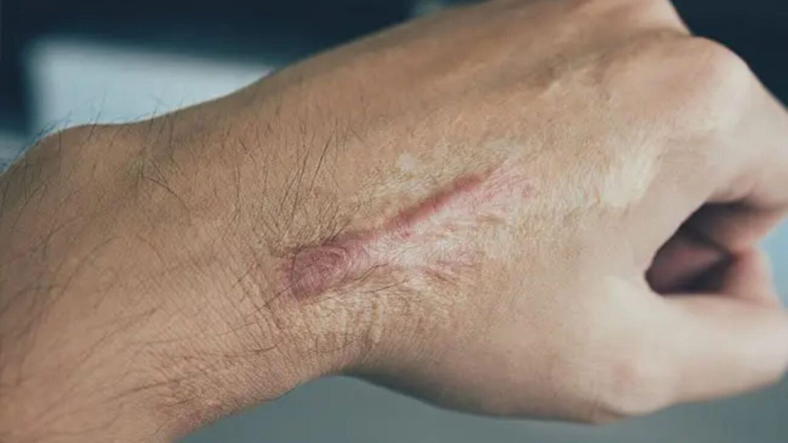 Color Stages of a Scar Timeline: How Healing Progresses | TheBeautyFoodie