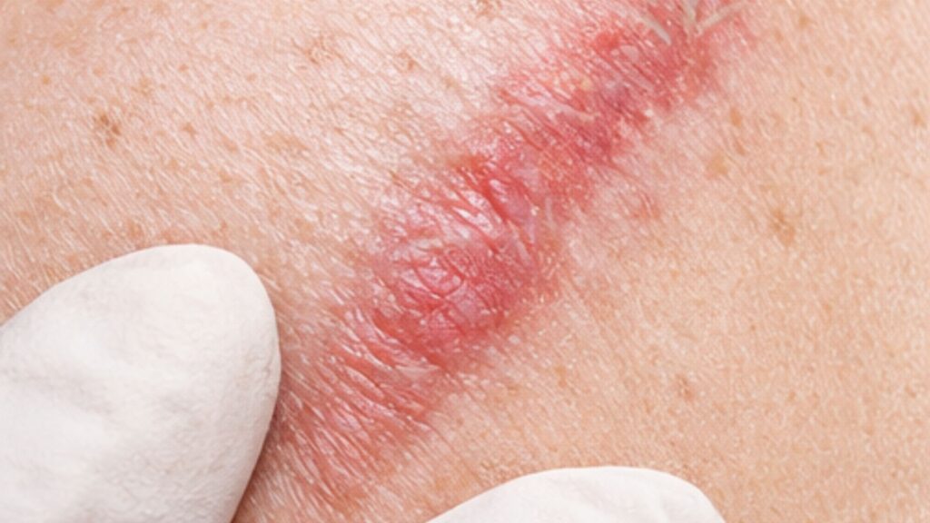 Color Stages of a Scar Timeline: How Healing Progresses | TheBeautyFoodie