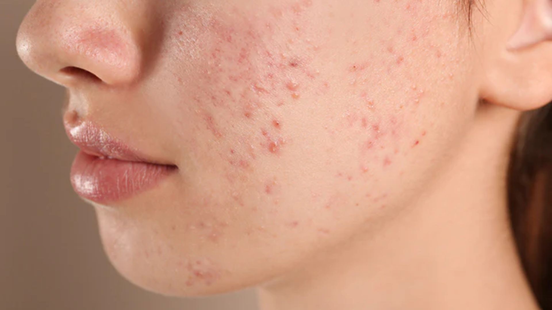 Do Eggs Cause Acne? What Research Shows | TheBeautyFoodie