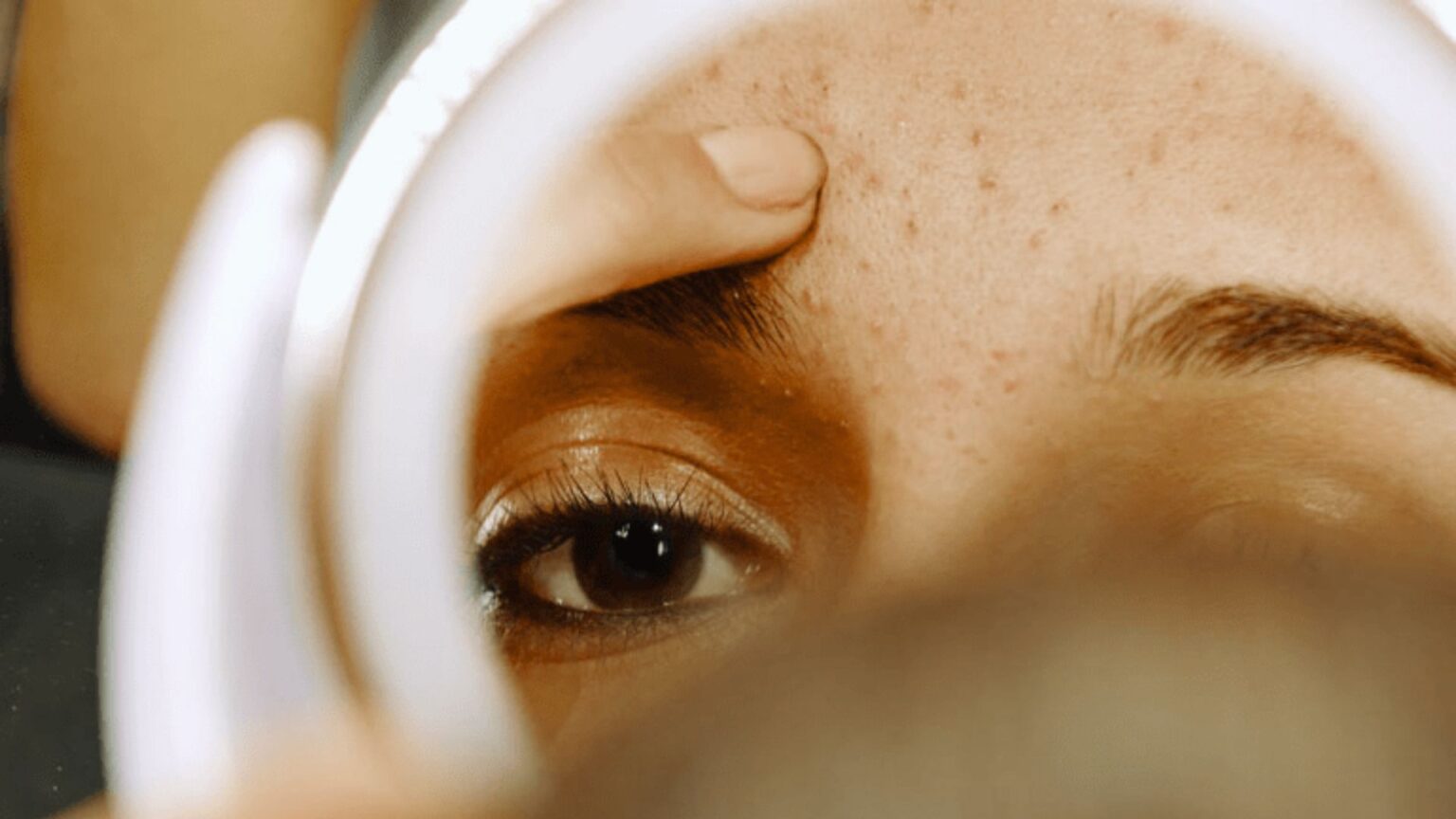 Stages of a Blind Pimple: Treatment Guide | TheBeautyFoodie