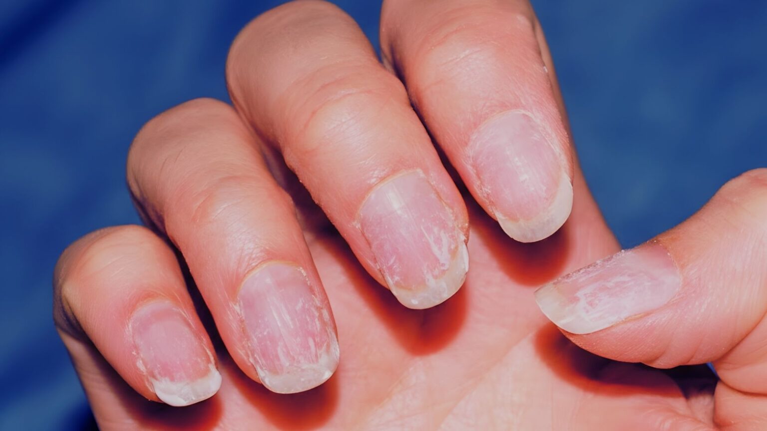 A Guide To Permanent Nail Matrix Damage: Protect Your Nails ...
