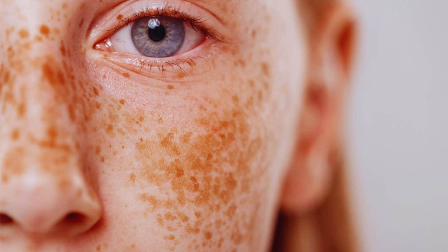 15 Types of Skin Blemishes and How to Identify Them | TheBeautyFoodie